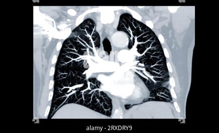 CTPA or CTA pulmonary artery for diagnostic Pulmonary embolism (PE ...