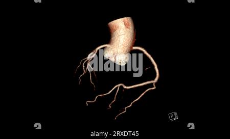 CT Cardiac 3D rendering or CTA coronary artery for prevention coronary ...