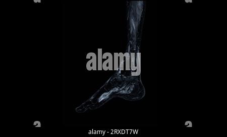 MRI FOOT scan Sagittal view T2 Fat suppression technique for diagnostic ...