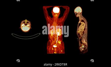 PET CT image of Whole human body sagittal plane. Positron Emission ...