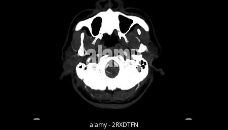 CTA BRAIN or CT angiography of the brain MIP technique image AP and ...