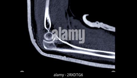 CT scan of elbow joint sagittal view Stock Photo - Alamy