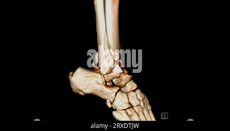 CT Scan ankle joint or Computed Tomography of Ankle joint 3D Rendering ...