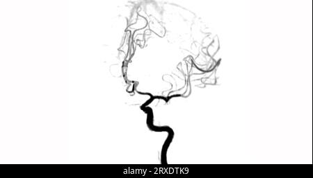 3D computed tomography (CT) angiogram scan of the heart of a 58 year ...