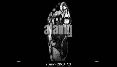 MRI FOOT scan Coronal view T2 technique for diagnostic tendon injury ...