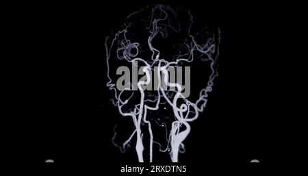 CTA BRAIN or CT angiography of the brain MIP technique image AP and ...