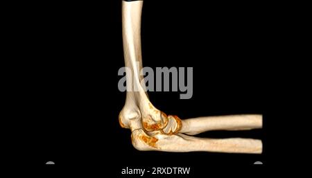 CT scan of elbow joint 3d rendering Stock Photo - Alamy