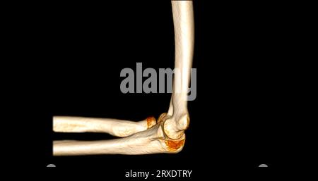 CT scan of elbow joint 3d rendering Stock Photo - Alamy