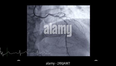 Cardiac catheterization on left anterior descending artery (LAD) can ...
