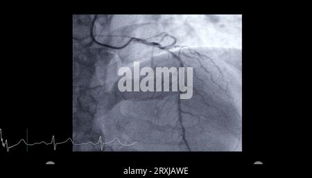 Cardiac catheterization on left anterior descending artery (LAD) can ...