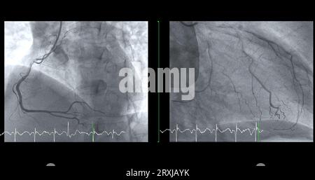 Cardiac catheterization on RCA and LAD can help doctor diagnose and ...
