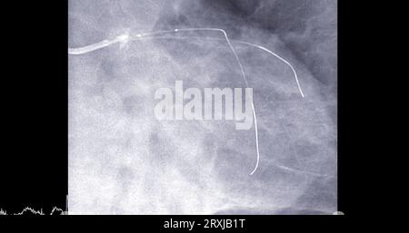 Cardiac catheterization on left anterior descending artery (LAD) can ...
