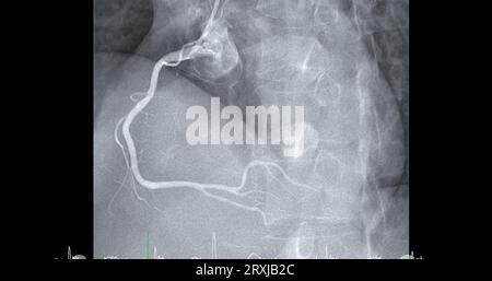 Cardiac catheterization on right coronary artery (RCA) can help doctor ...
