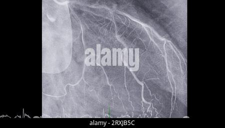 Cardiac catheterization on left anterior descending artery (LAD) can ...