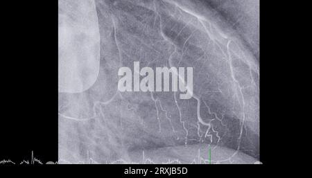 Cardiac catheterization on left anterior descending artery (LAD) can ...