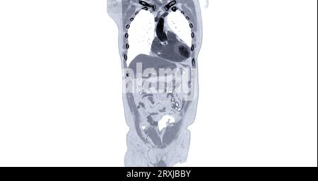CT Scan of whole body with injection contrast media coronal view for ...