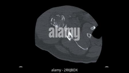 CT Scan of Shoulder joint in case fracture shoulder joint Stock Photo ...