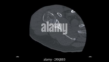 CT Scan of Shoulder joint in case fracture shoulder joint Stock Photo ...