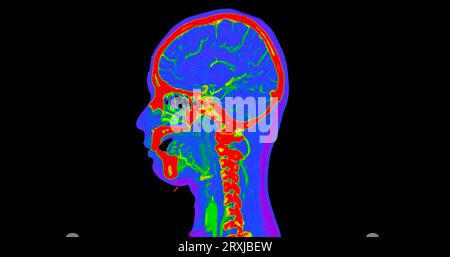 CT angiography of the brain or CTA brain and neck Sagittal view 3D ...
