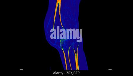 CT Scan of Knee joint sagittal and coronal in case fracture patella ...