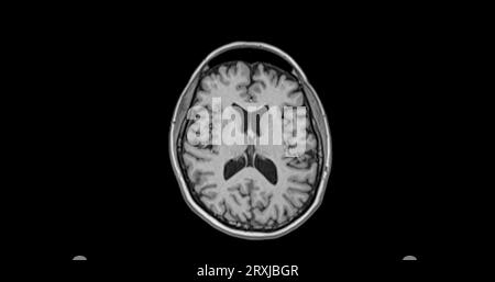 MRI scan of the brain for detect Brain diseases sush as stroke disease, Brain tumors and ...