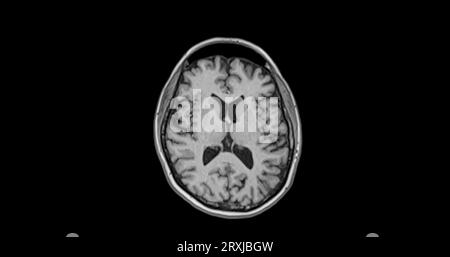 MRI scan of the brain for detect Brain diseases sush as stroke disease, Brain tumors and ...