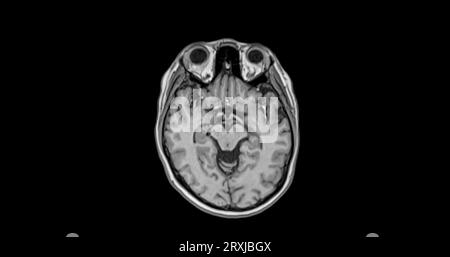 MRI scan of the brain for detect Brain diseases sush as stroke disease, Brain tumors and ...