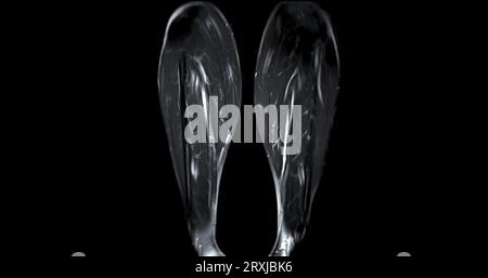 MRI Scan of both leg coronal view Stock Photo - Alamy