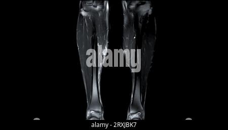 MRI Scan of both leg coronal view Stock Photo - Alamy