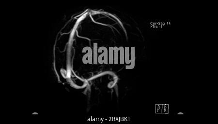 MRV Brain or magnetic resonance venography of The Brain for diagnosis ...