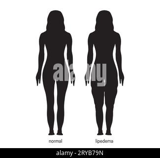 Lipedema Silhouette Illustration with Woman with Normal and Lipedema ...