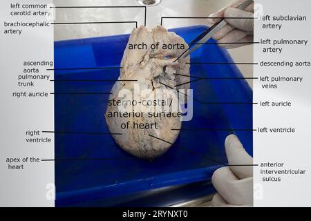 dissection image of the muscle of the thigh with showing sciatic nerve ...