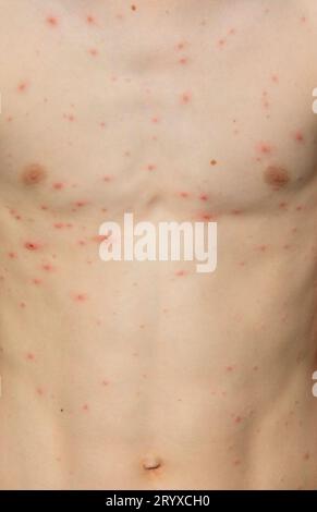 Child with chickenpox varicella zoster infection Stock Photo - Alamy