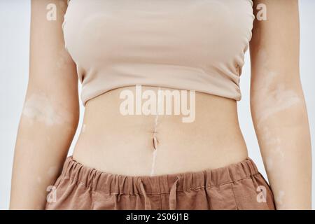 Midsection of woman with vitiligo patches on arms and belly in ...