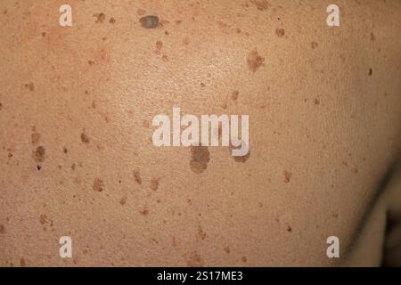 Brown spots and freckles on the back of an old man. Skin problems Stock ...