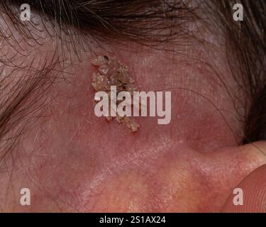 Close-up of a skin lesion on the shin of the leg of an 82 year old ...