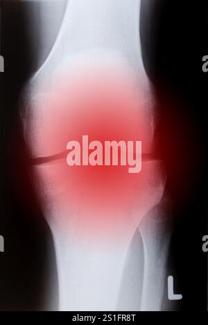 X-ray image of the left knee from the front Stock Photo - Alamy