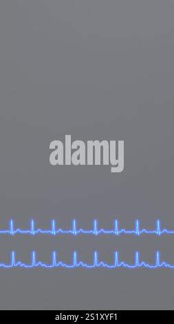 Comparison of ECG of normal heart rhythm and AV block 2nd degree Stock ...
