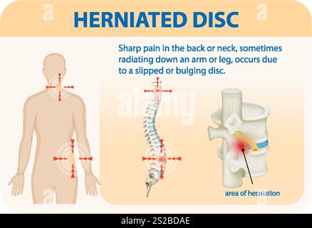 Illustration of herniated disc and pain areas Stock Vector Image & Art ...