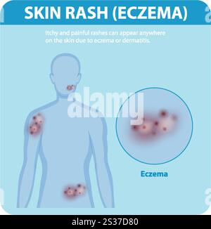 Illustration of eczema symptoms on human skin Stock Vector Image & Art ...