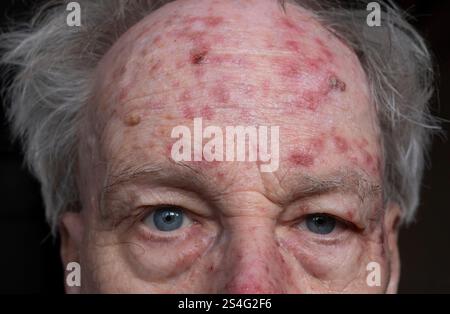 Red crusty lesions of actinic keratosis or sunspots on sun-damaged skin ...