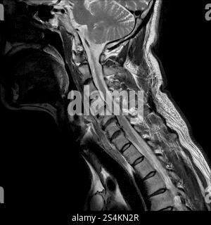 Sagittal view of magnetic resonance image of MRI of cervical spine ...