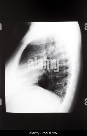side view of human thorax with lungs on X-ray image Stock Photo - Alamy