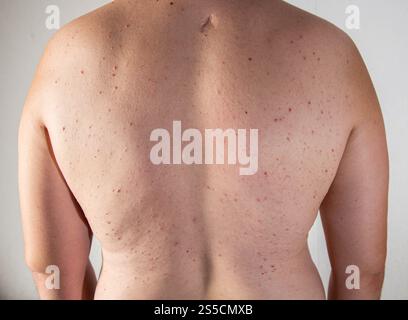 Red pimples on a man's back. Hormonal imbalance and increased ...