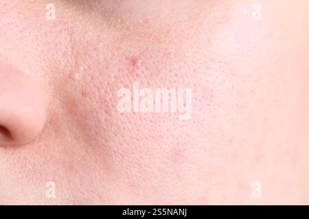 Texture of skin with enlarged pores as background, closeup Stock Photo ...