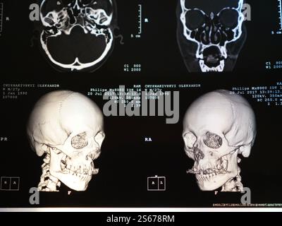 MRI of the human brain of a patient with multiple sclerosis of the ...