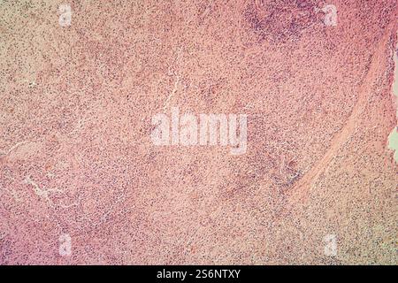 Scars in the heart muscle 100x Stock Photo - Alamy