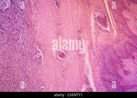 Tonsils diseased tissue 100x Stock Photo - Alamy