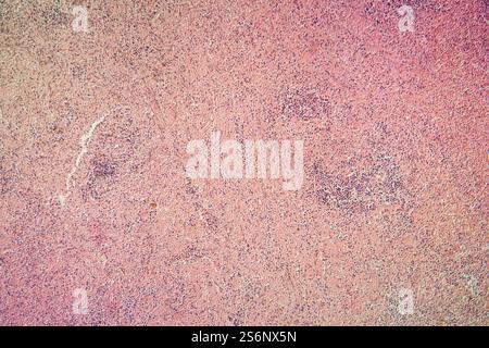Heart calluses scars in the heart muscle 100x Stock Photo - Alamy