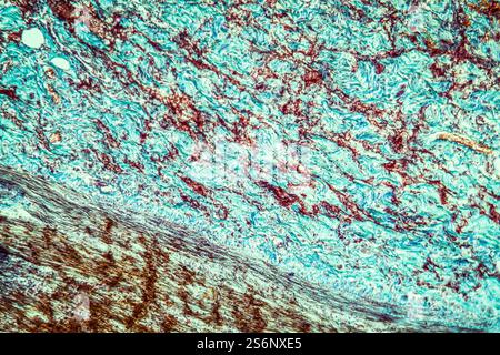 Large intestine diseased tissue 100x Stock Photo - Alamy